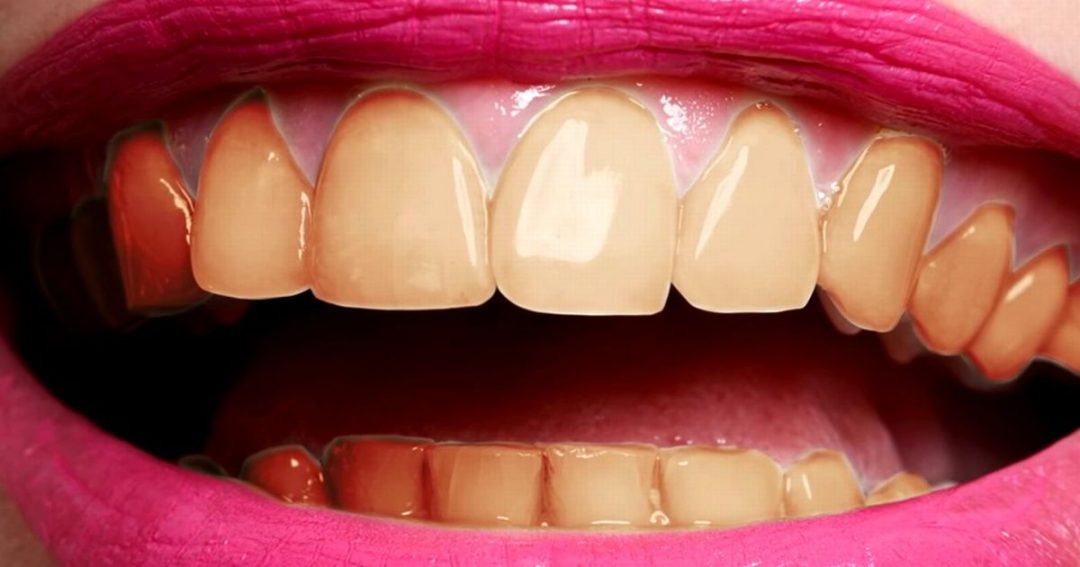 Why Are My Teeth So Yellow? Common Causes And Simple Cures | Bloor West ...